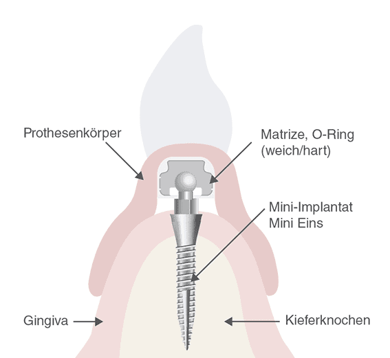 Mini-Implantate – Günstiger Zahnersatz – Meine schönsten Zähne
